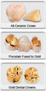 Dental Crowns - Ocotillo Dental Care | Dentist Chandler, AZ